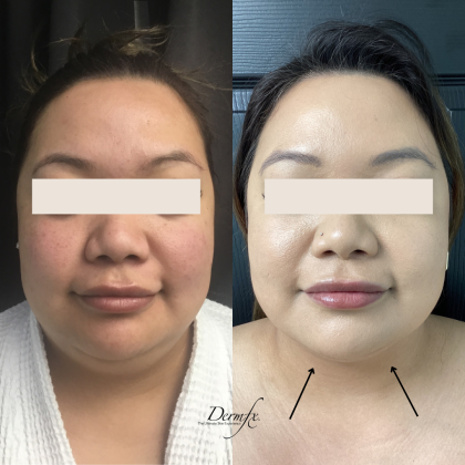 Bye Bye Double Chin: 3 Treatments to Get Rid of Your Double Chin and ...