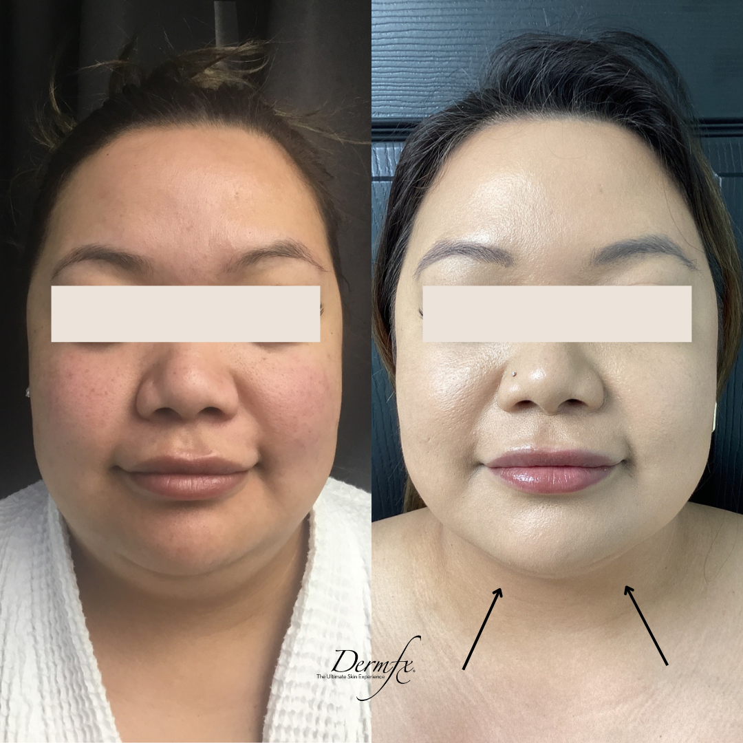 Bye Bye Double Chin: 3 Treatments to Get Rid of Your Double Chin and ...