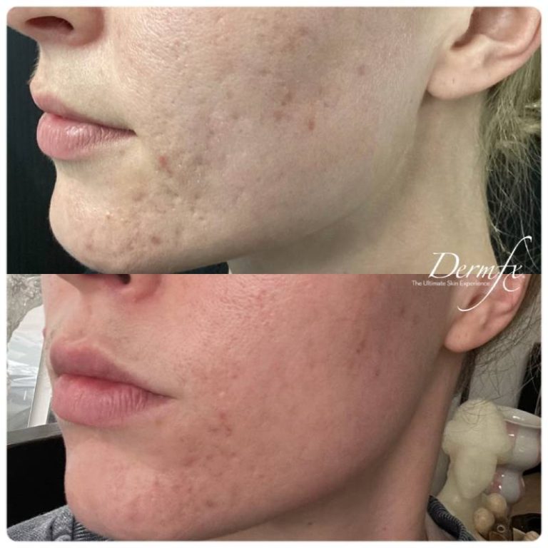 Unveiling the Power of Cosmetic Laser Treatments for Radiant Skin | DermFx