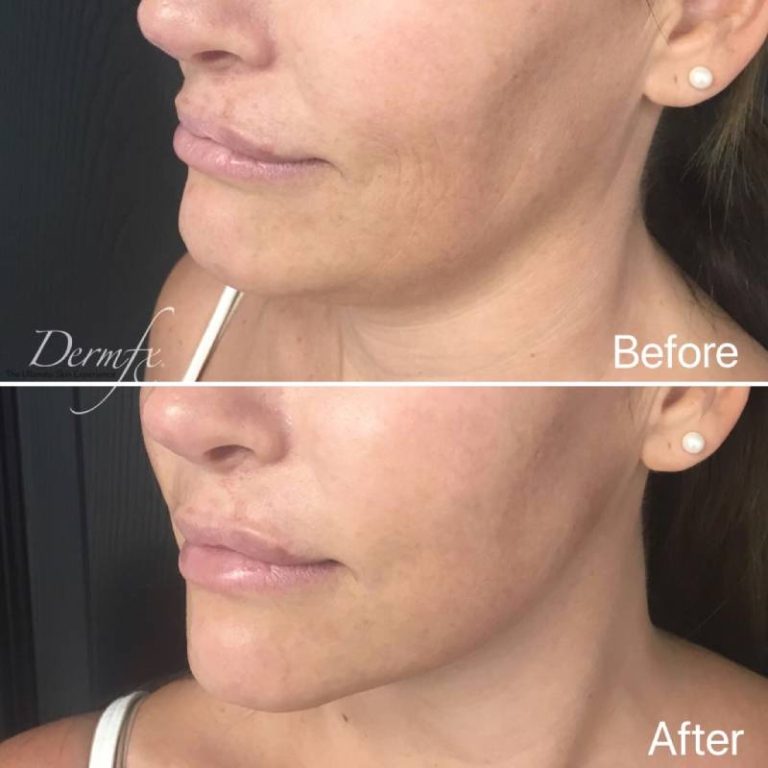 Unveiling the Power of Cosmetic Laser Treatments for Radiant Skin | DermFx