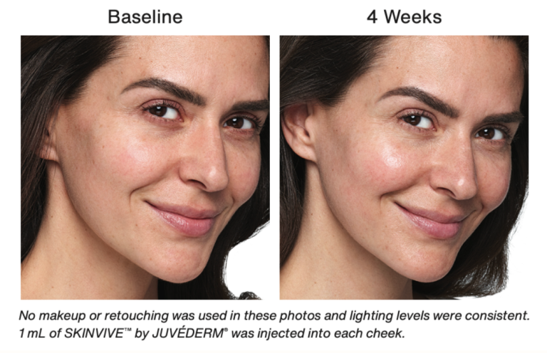 Introducing SkinVive by Juvederm: The NEW Microdroplet Injectable for ...